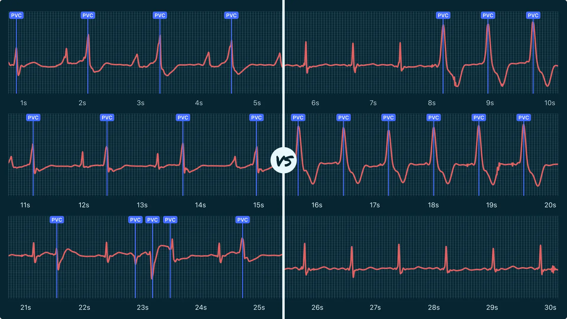 Ventricular Tachycardia (Non-Sustained) Vs. Accelerated Idioventricular ...