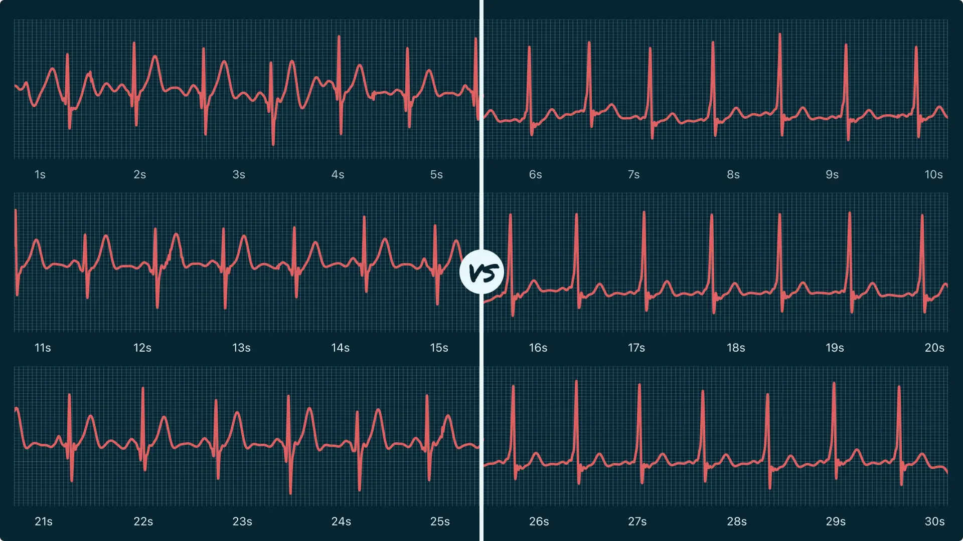 Sinus Rhythm Vs. Wolff-Parkinson-White Syndrome on Your Watch ECG | Qaly