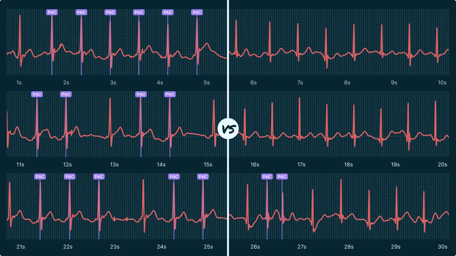 Ectopic Atrial Rhythm Vs. Premature Atrial Contraction (Couplet) on ...