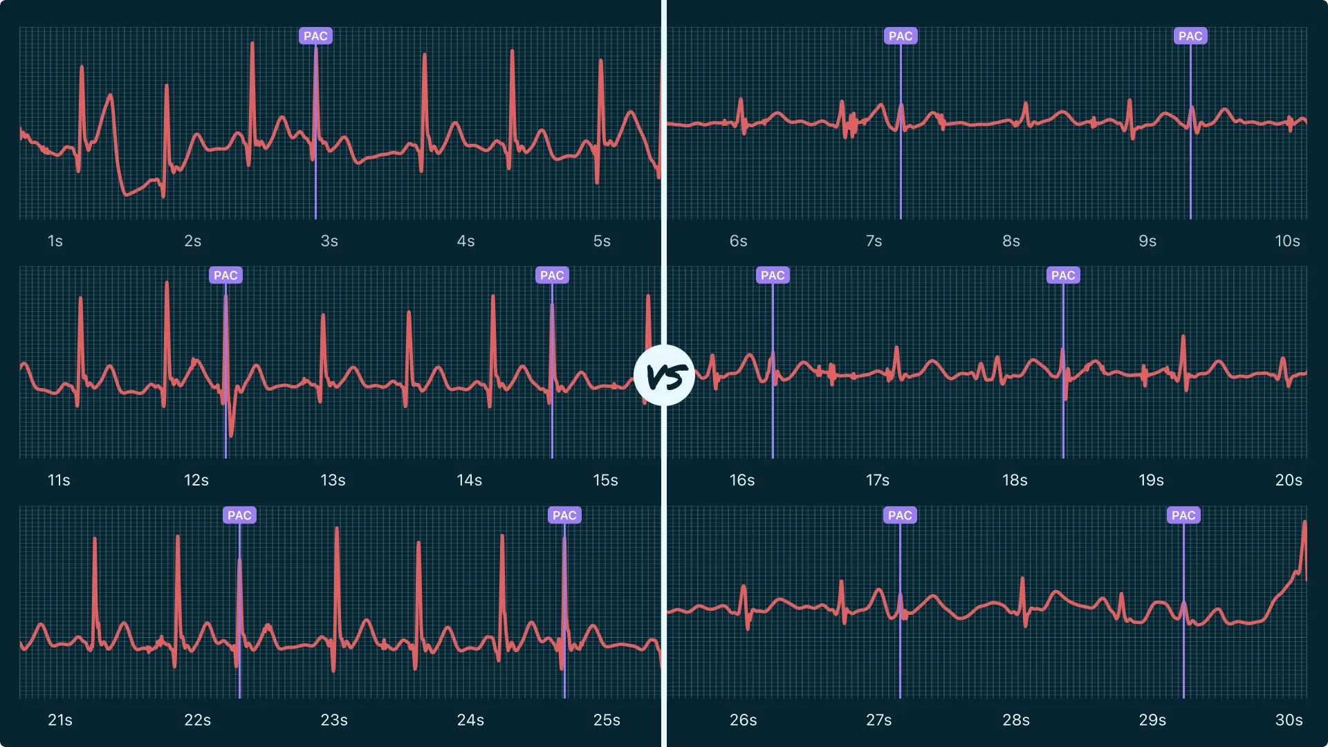 Premature Atrial Contraction (Multiple) Vs. Atrial Trigeminy on Your ...