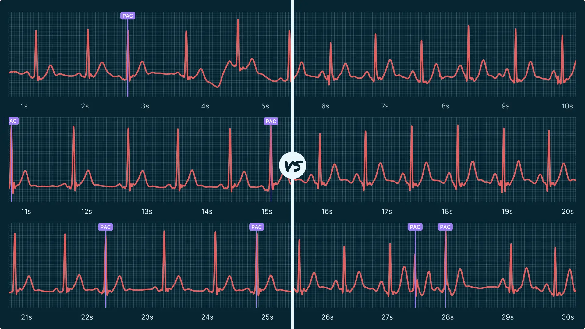 Premature Atrial Contraction (Multiple) Vs. Premature Atrial ...