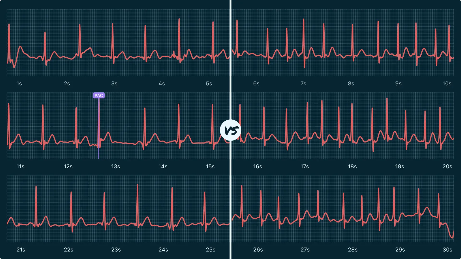 Premature Atrial Contraction (Single) Vs. Atrial Fibrillation on Your ...