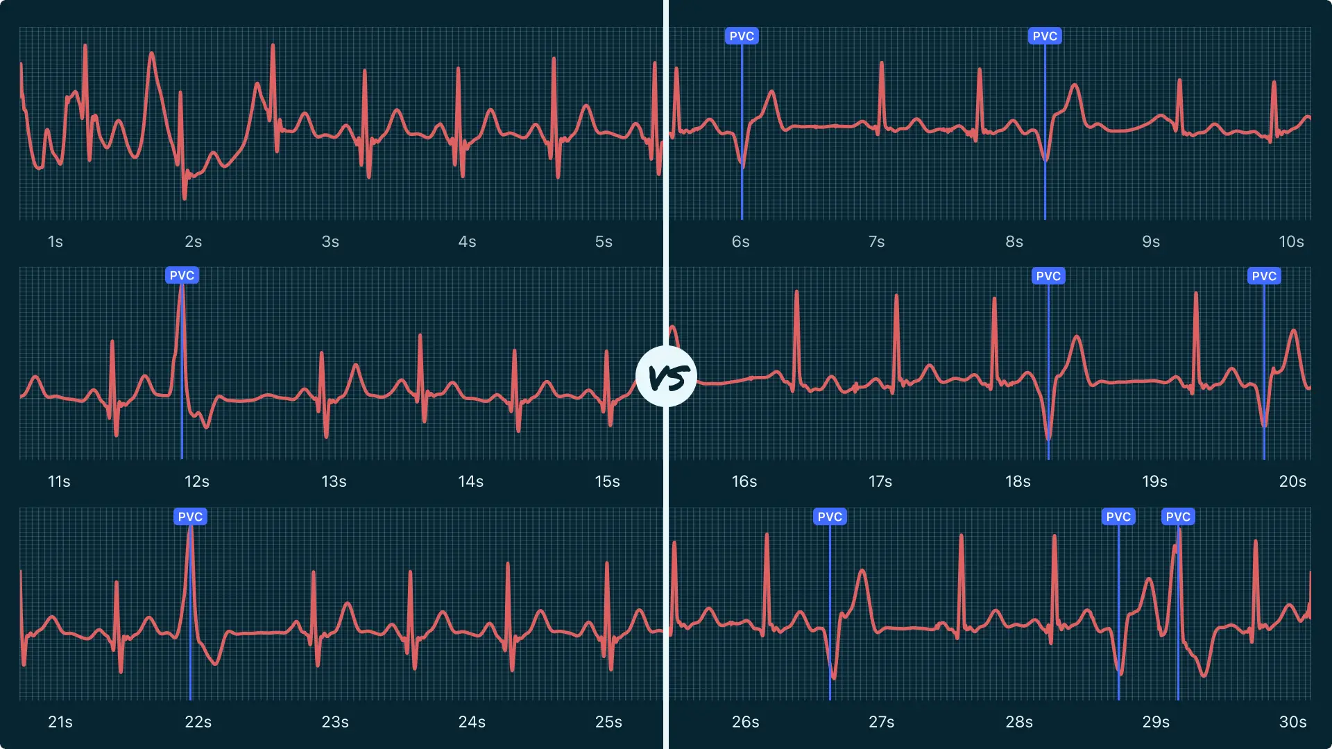 Premature Ventricular Contraction (Multiple) Vs. Premature Ventricular ...