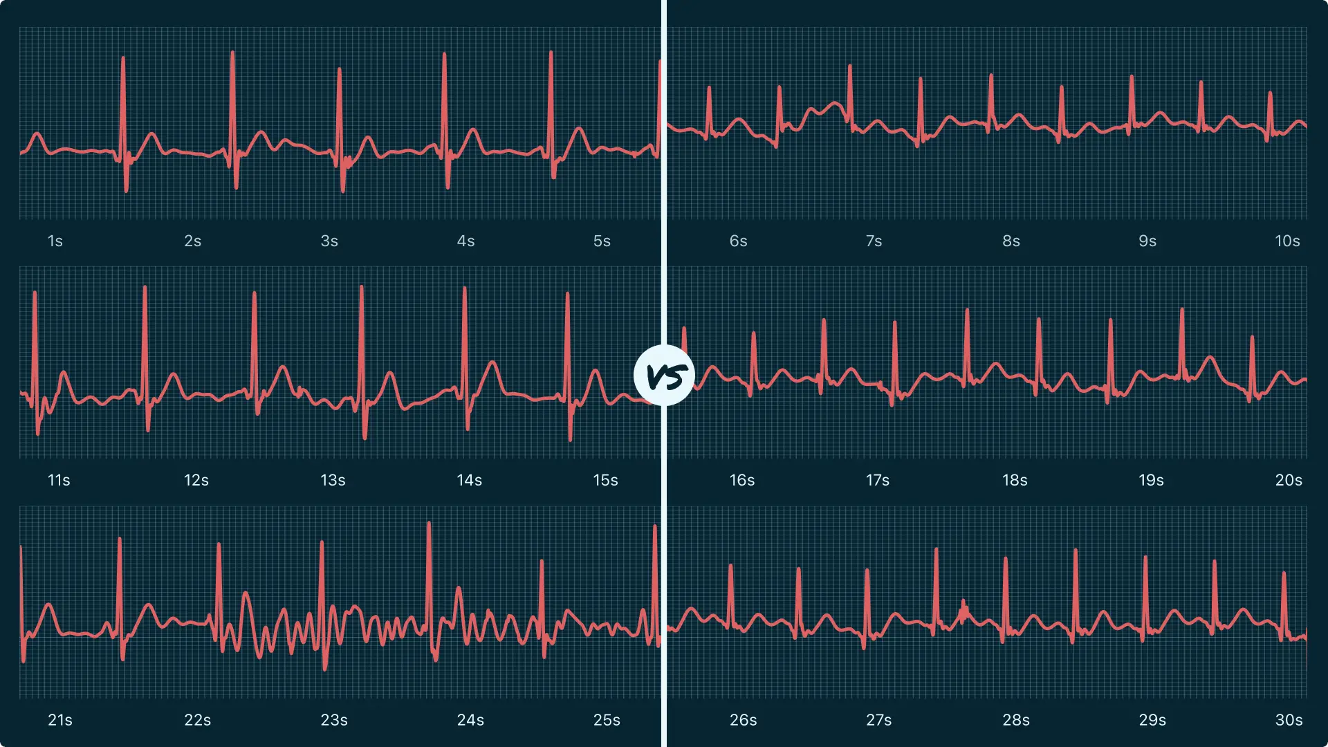 Sinus Rhythm Vs. Sinus Tachycardia on Your Watch ECG | Qaly