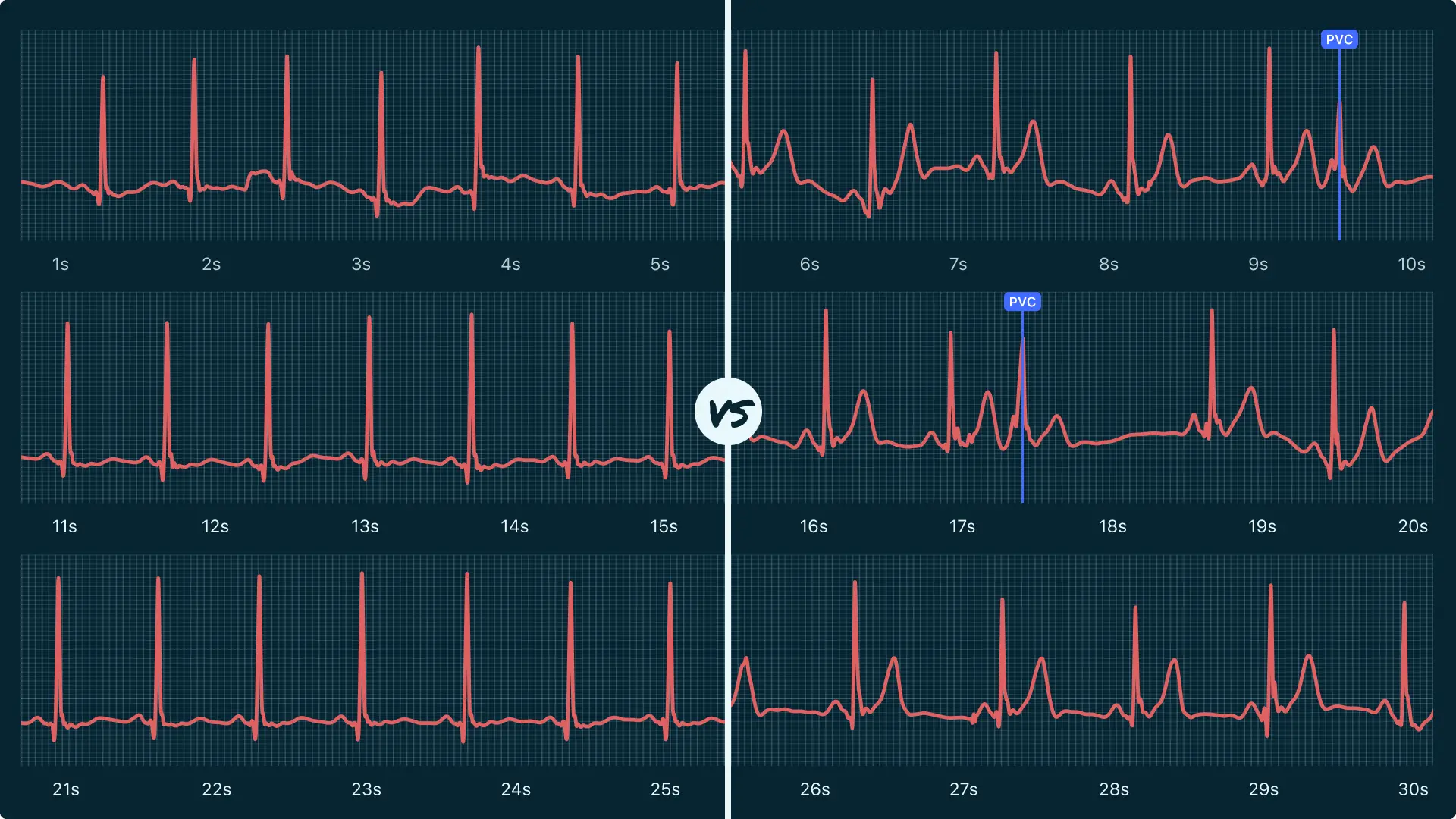 Sinus Rhythm Vs. Premature Ventricular Contraction (Multiple) on Your ...