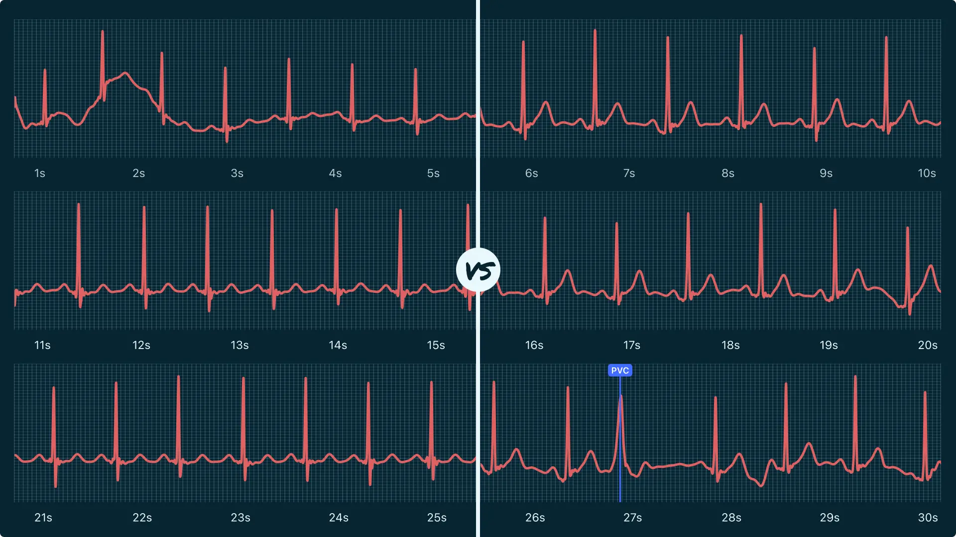 Sinus Rhythm Vs. Premature Ventricular Contraction (Single) on Your ...