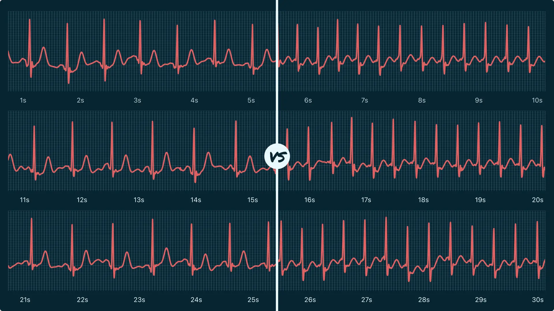 Sinus Rhythm Vs. Supraventricular Tachycardia (Sustained) on Your Watch ...