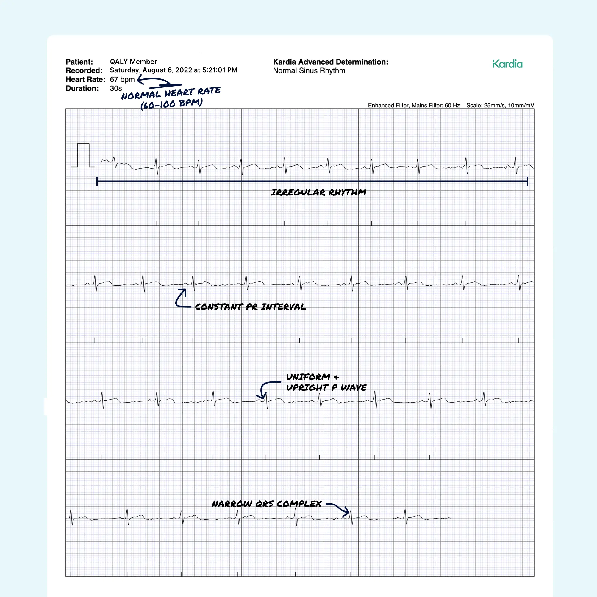 Sinus Rhythm Vs. Sinus Arrhythmia on Your Watch ECG | Qaly