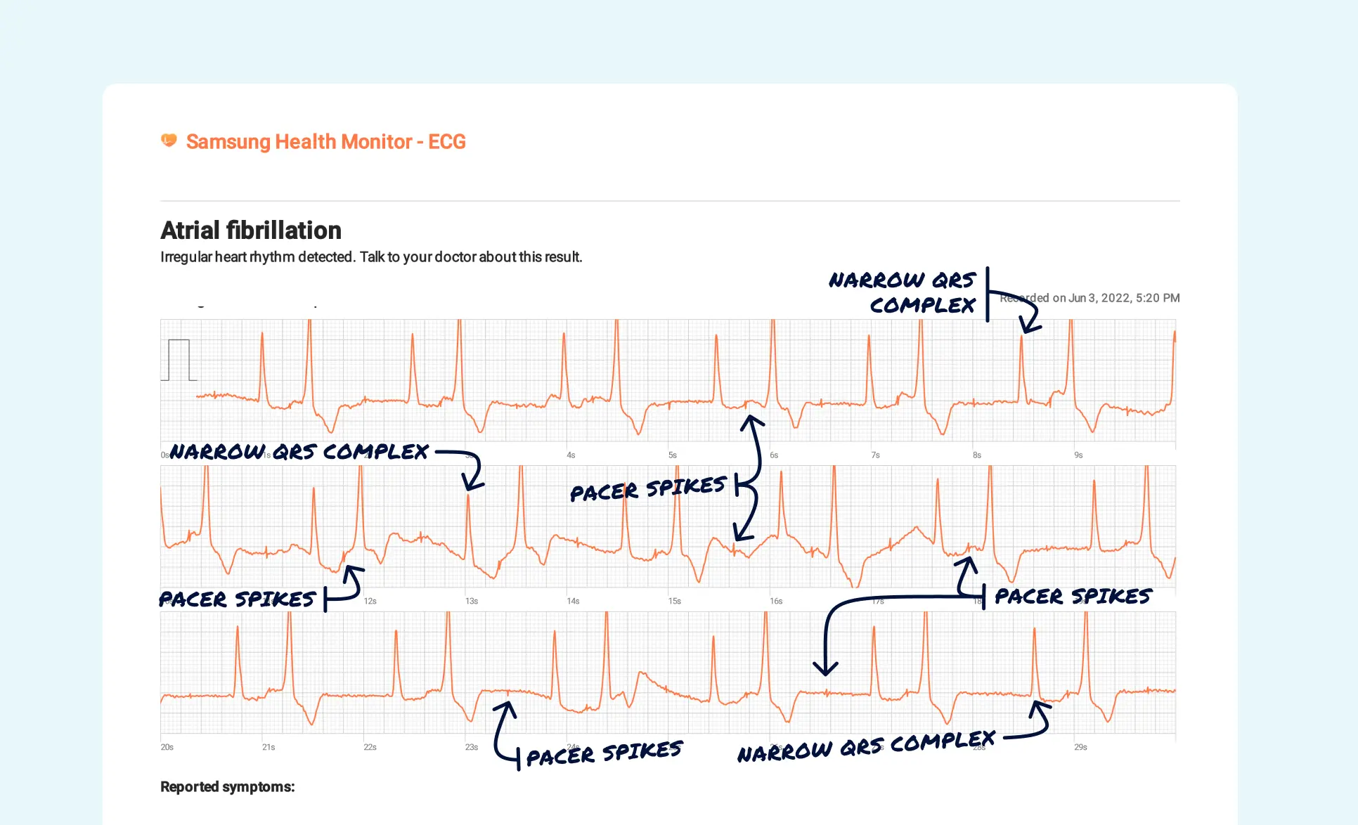 Paced Rhythm Vs. Sinus Rhythm on Your Watch ECG | Qaly