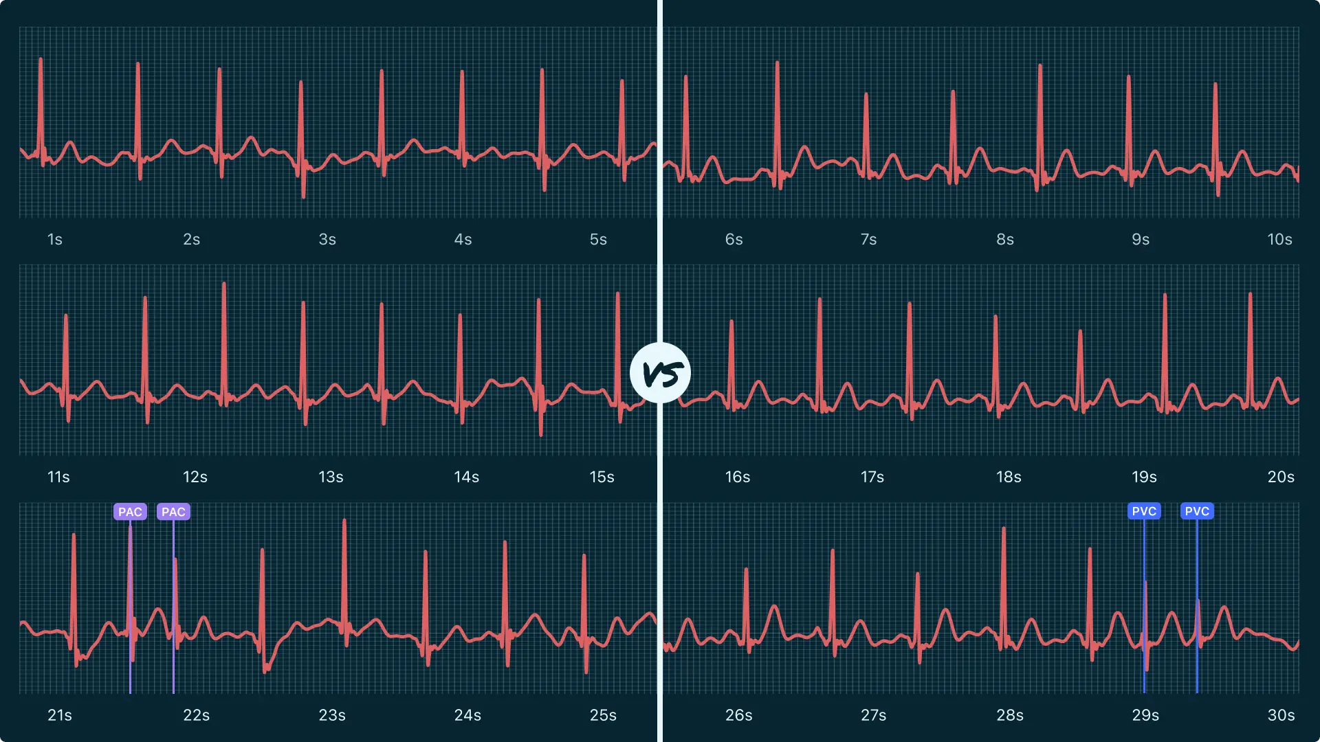 Premature Atrial Contraction (Couplet) Vs. Premature Ventricular ...