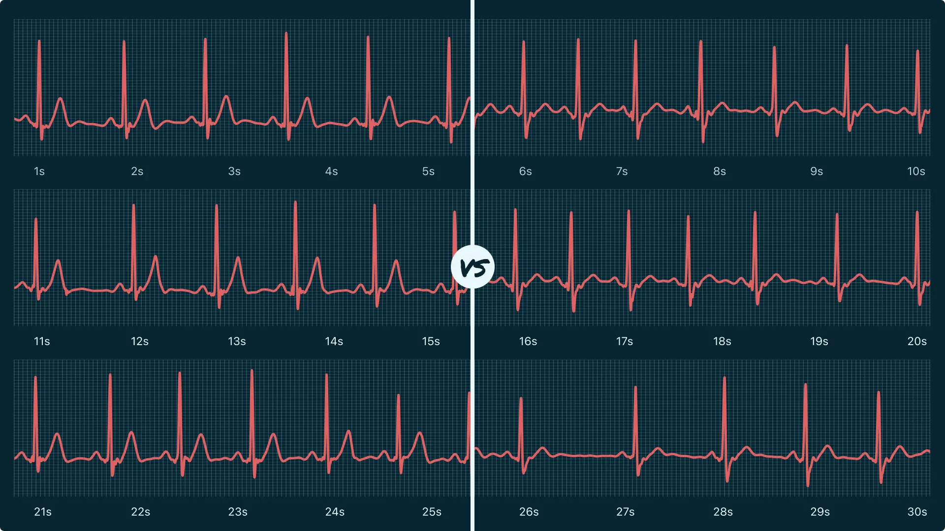 Sinus Arrhythmia Vs. Sinus Pause