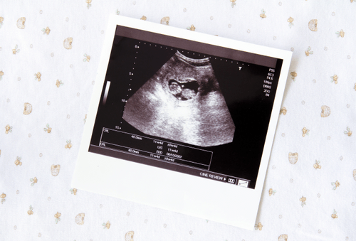 Early Pregnancy: What to expect in your 6 week ultrasound