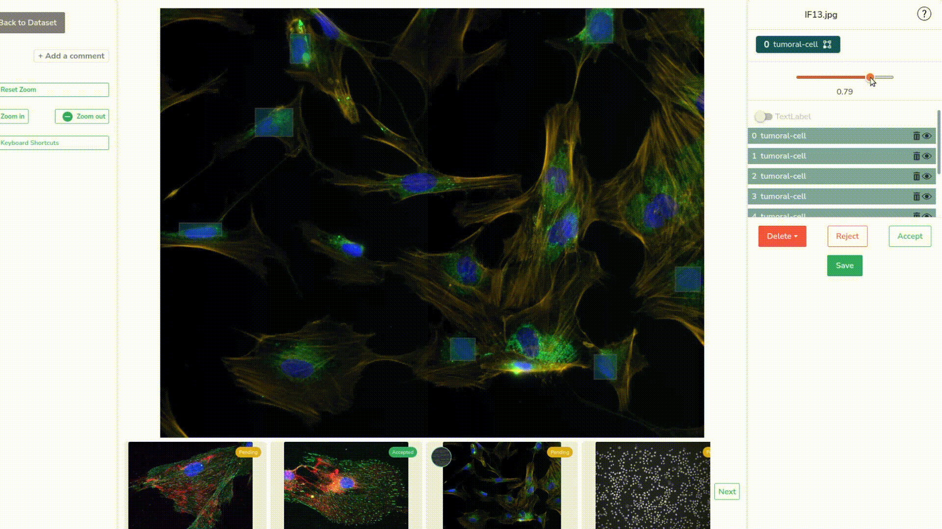 How to Use Computer Vision in Cancer Research With MLOps — Picsellia