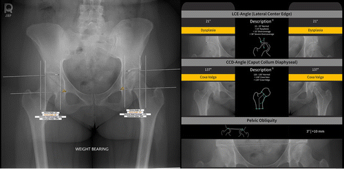 AI Diagnosis of Hip Misalignments proves Reliable, Fast and Cost ...