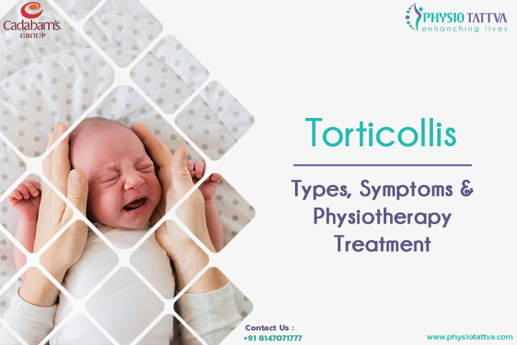 Torticollis: Symptoms, Causes, Types & Treatments