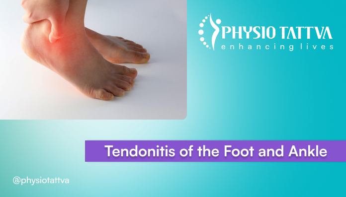 Foot & Ankle Tendonitis - Causes, Symptoms & Treatments
