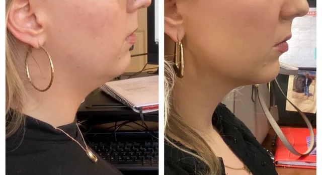 Mewing Before & After: 122+ Progress Photos (Male & Female Transformations)