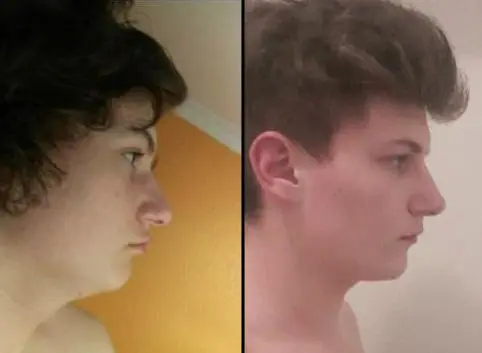 Mewing Before & After: 122+ Progress Photos (Male & Female Transformations)