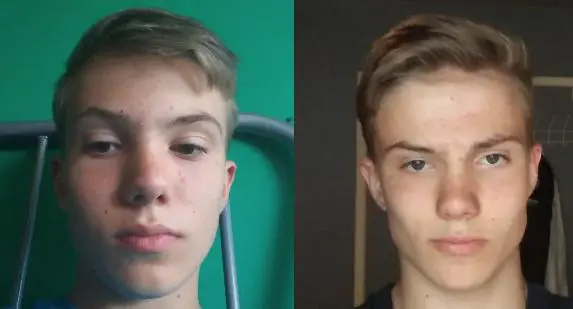 Mewing Before & After: 122+ Progress Photos (Male & Female Transformations)