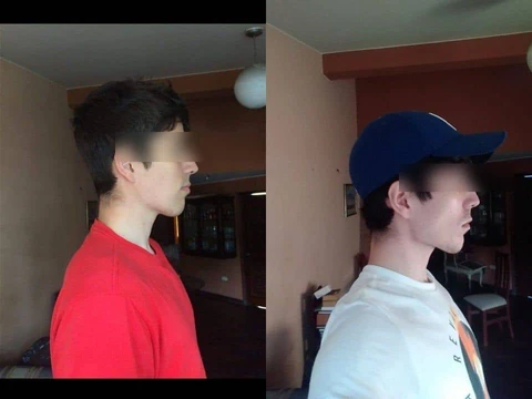 Mewing Before & After: 122+ Progress Photos (Male & Female Transformations)