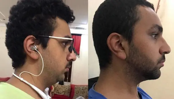 Mewing Before & After: 122+ Progress Photos (Male & Female Transformations)