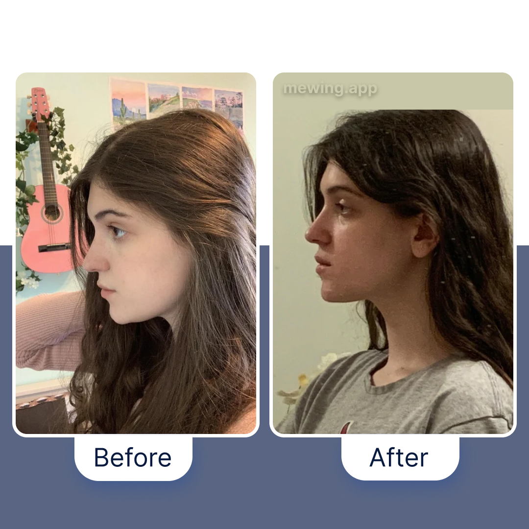 Mewing Before & After: 122+ Progress Photos (Male & Female Transformations)