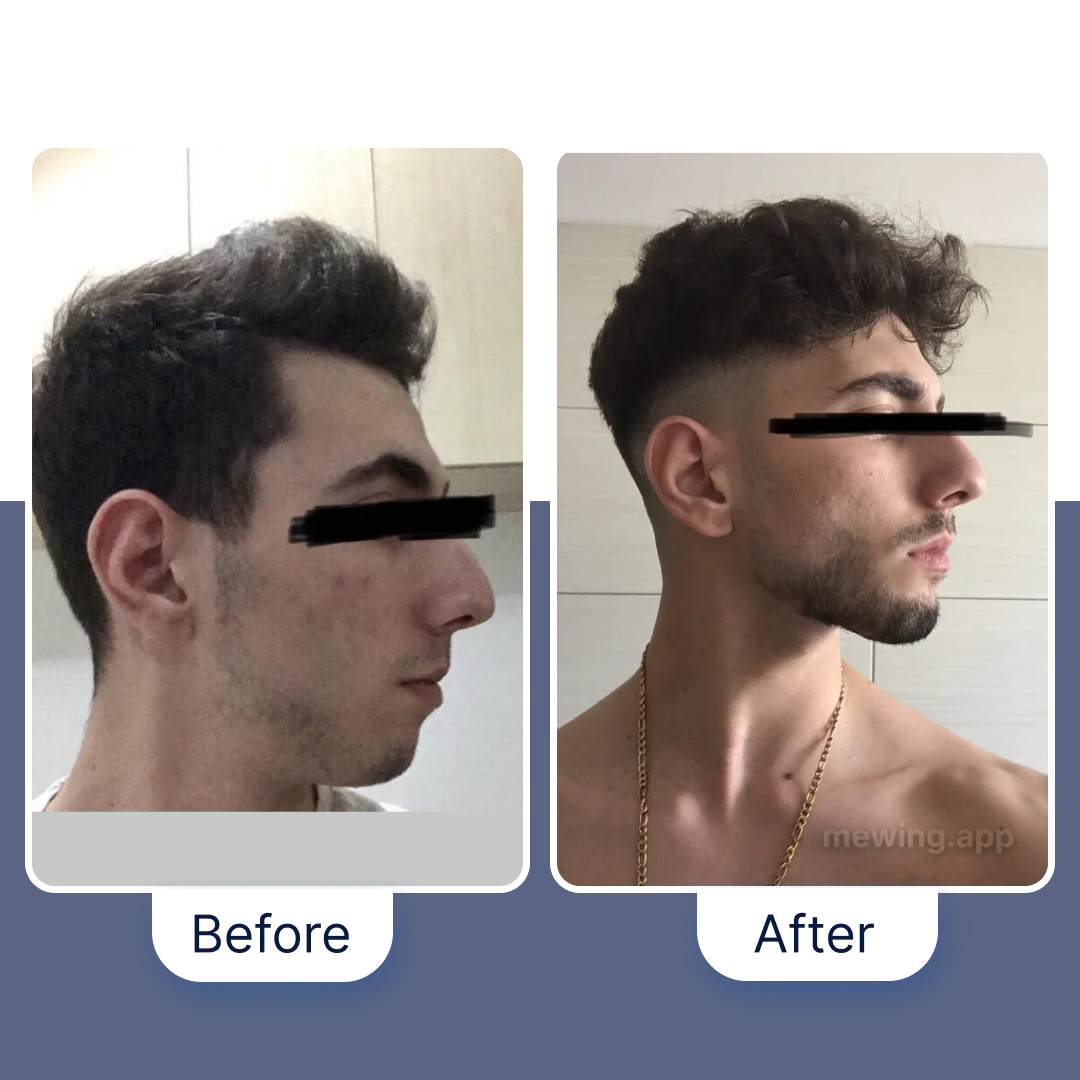 Mewing Before & After: 122+ Progress Photos (Male & Female Transformations)