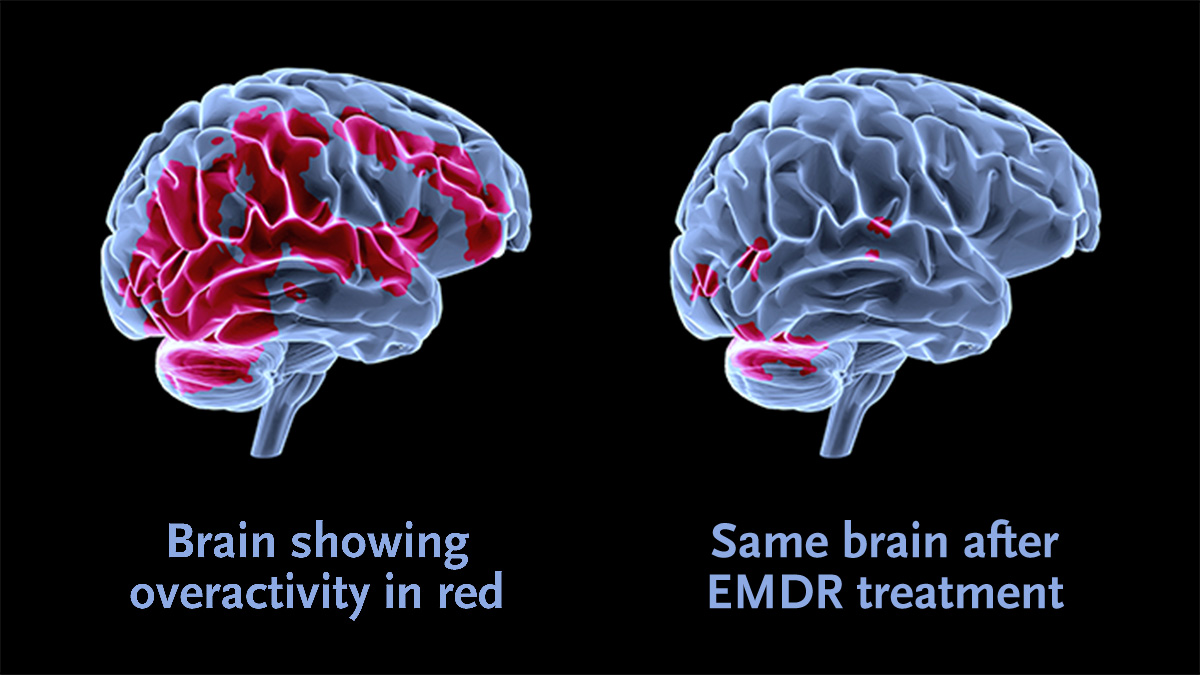 Understanding Eye Movement Desensitization and Reprocessing (EMDR)