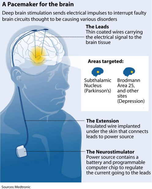 Brain Stimulation Overcoming Stigma