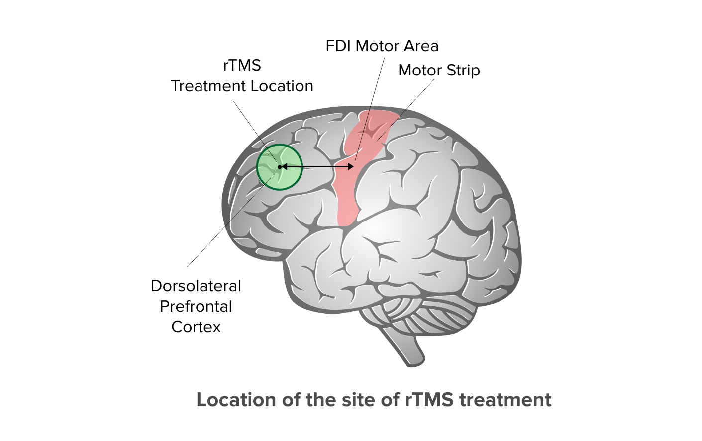 The Ultimate Patient's Guide to TMS Therapy