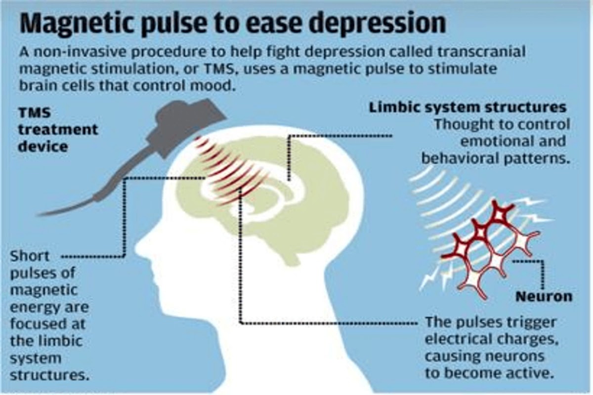TMS For Depression: Everything You Need to Know