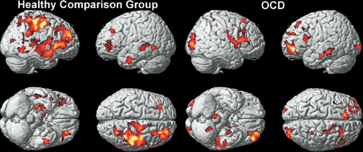 Treatment of OCD Now Approved by FDA Using Transcranial Magnetic ...