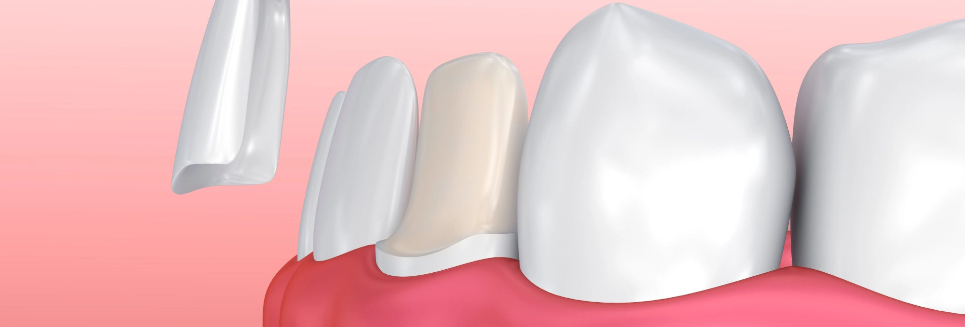 Can You Remove Stains From Veneers?