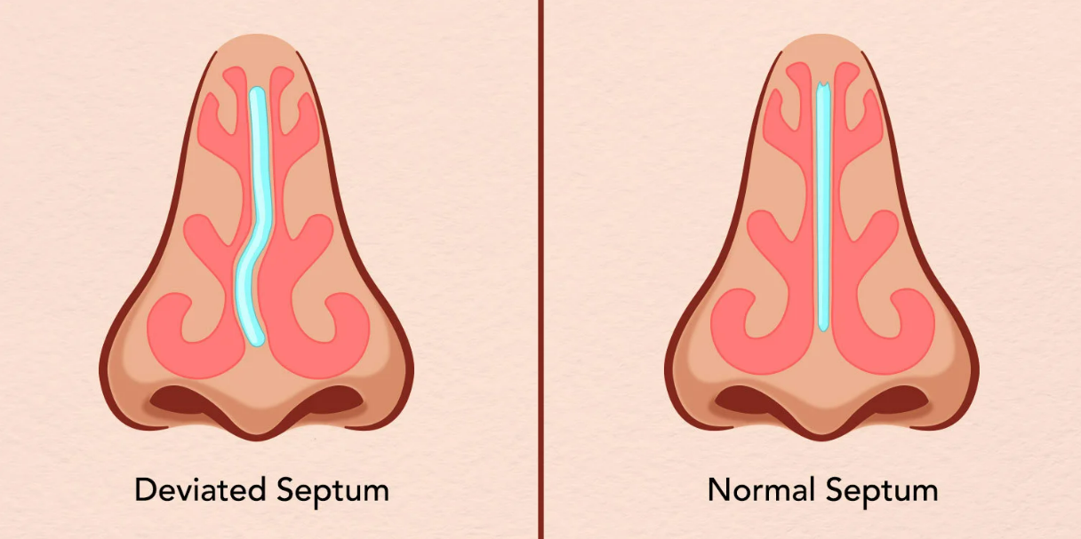 What to Expect from a Septorhinoplasty Procedure - Dr. Mohaghegh ...
