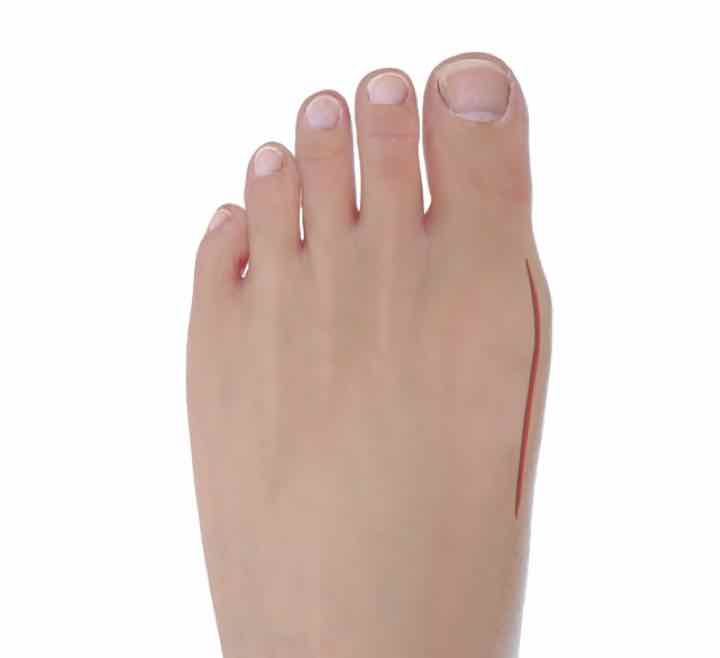Bunion Correction Surgery | Arthrex Bunionectomy