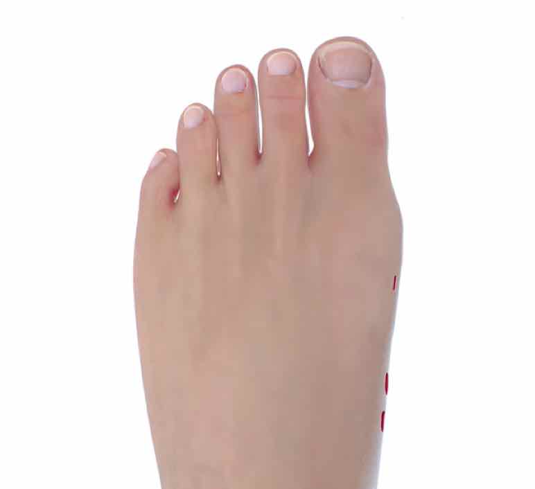 Bunion Correction Surgery | Arthrex Bunionectomy