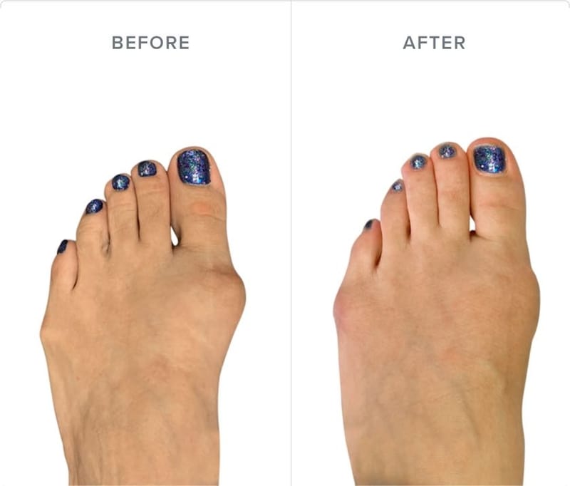 Bunion Correction Surgery | Arthrex Bunionectomy