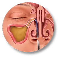 Balloon Sinuplasty: Breathe Better at Our Sinus Relief Center