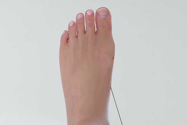 Arthrex Bunionectomy Blog | Surgeons Walk Through the Procedure