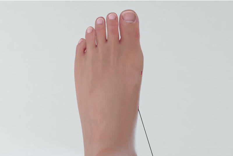 Arthrex Bunionectomy Blog | Surgeons Walk Through the Procedure