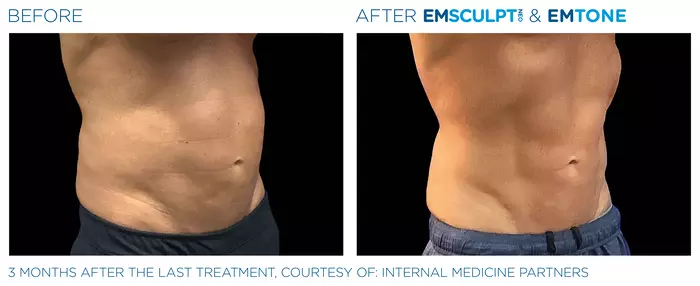 EMSculpt Dubai - Before and After - Novelty Clinic