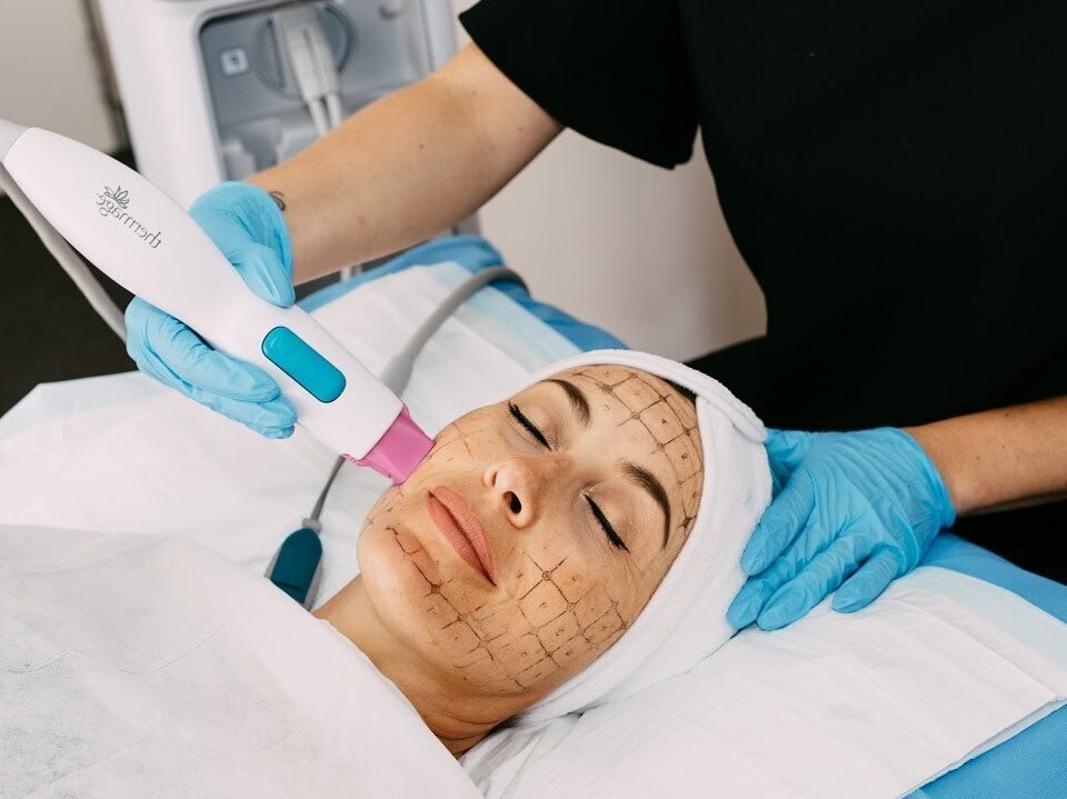 Thermage | skin tightening in Dubai