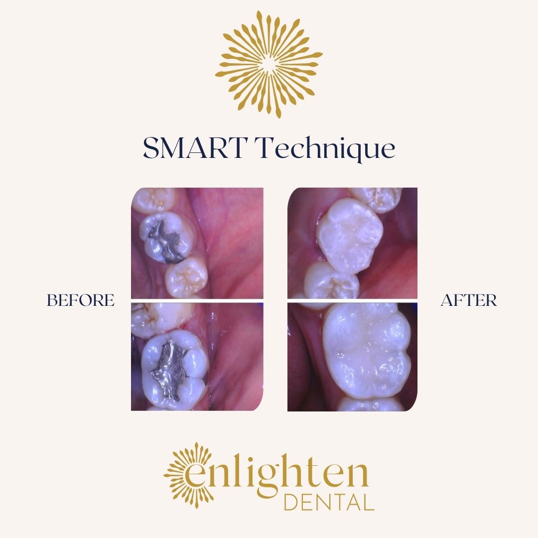 The SMART Approach to Amalgam Removal