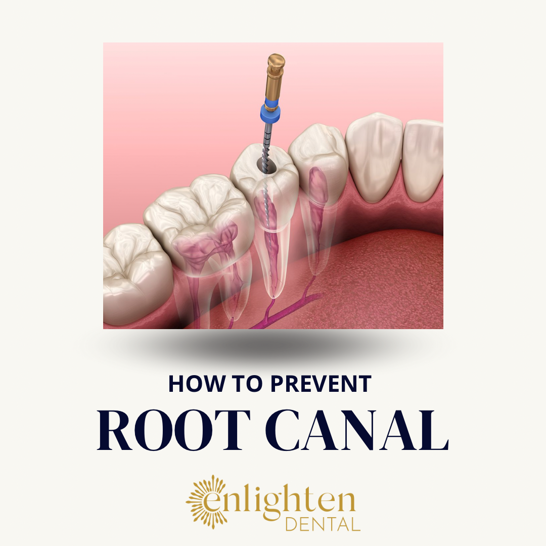 How to Prevent a Root Canal