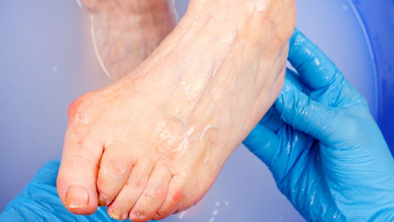 Temperature Monitoring for Diabetic Foot Care is the Gold Standard