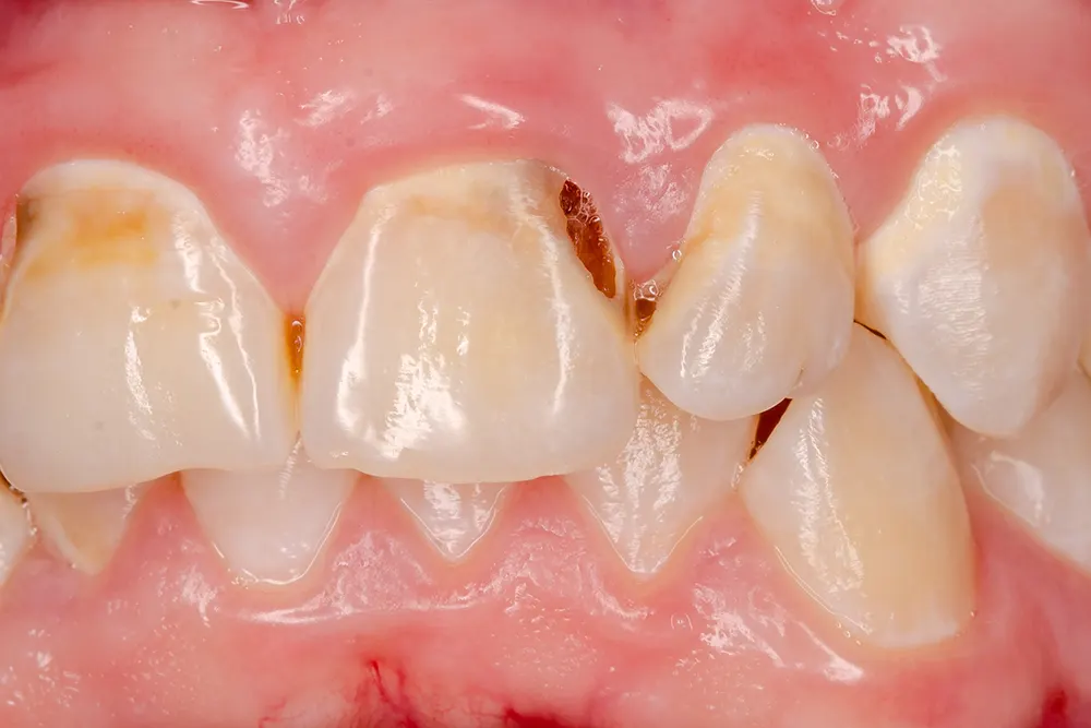 5 Signs of Tooth Decay in Children | Limestone Pediatric Dentistry