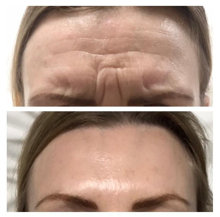 Frown lines | Alisha Louise Aesthetics | Skelmersdale