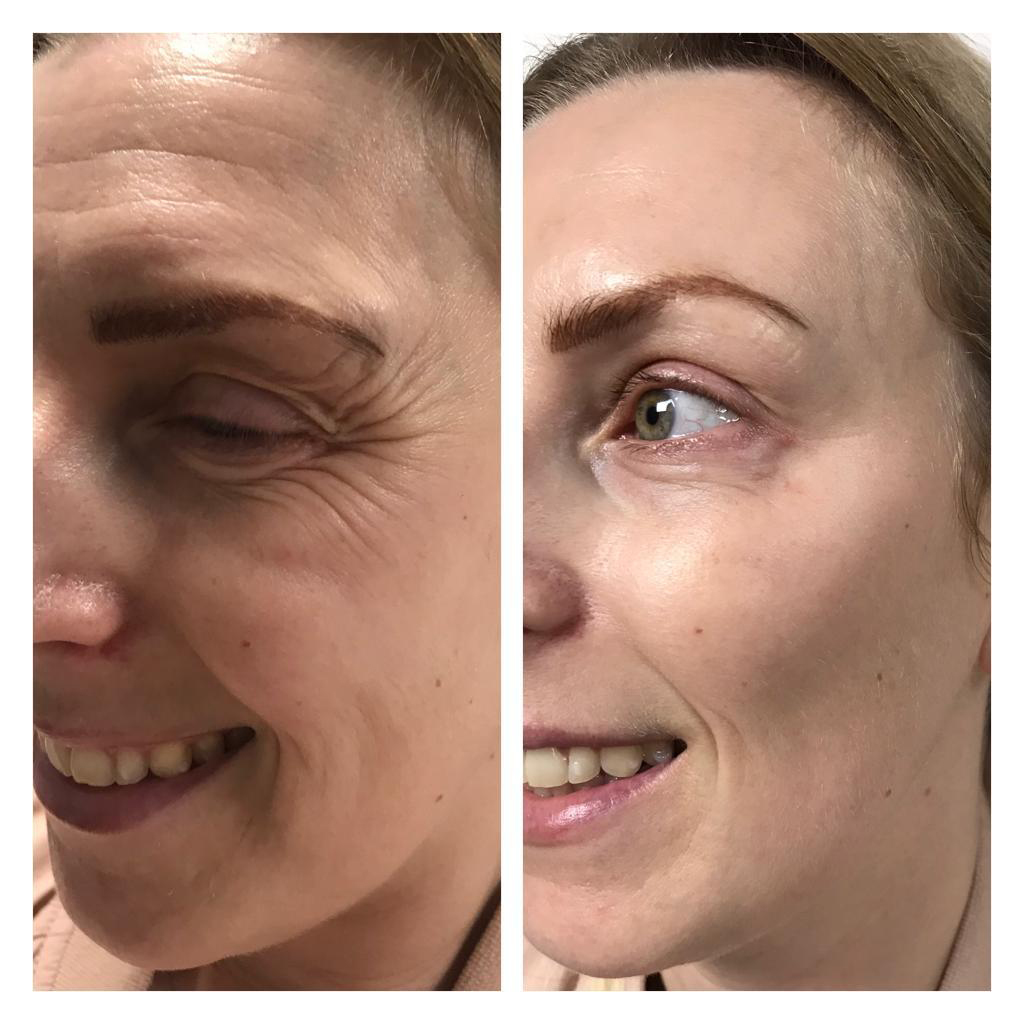 Crows feet | Alisha Louise Aesthetics | Skelmersdale