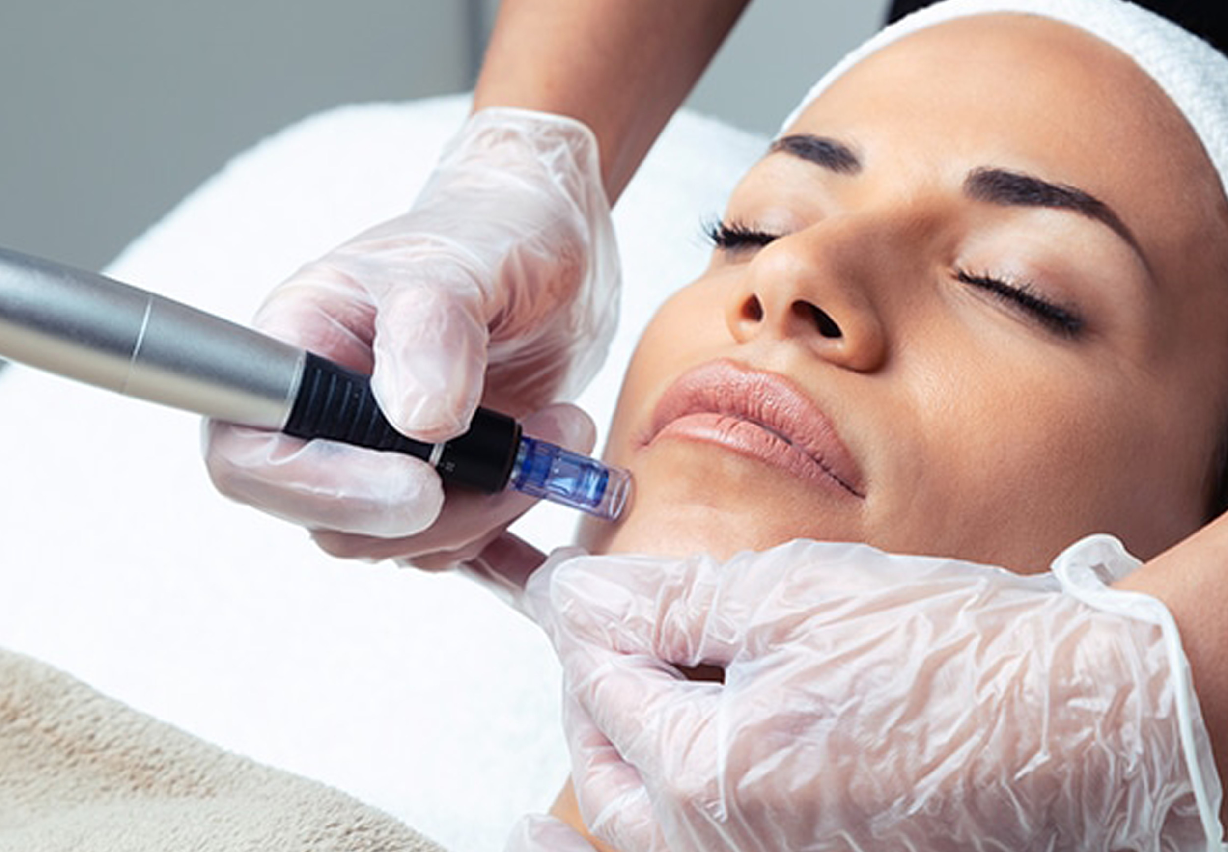 Micro Needling | Alisha Louise Aesthetics | Skelmersdale