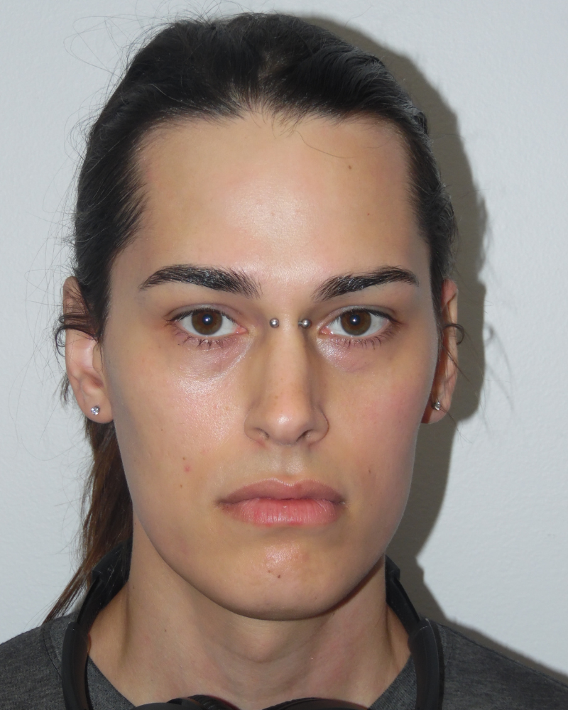 Facial Feminization | Stiller Aesthetics